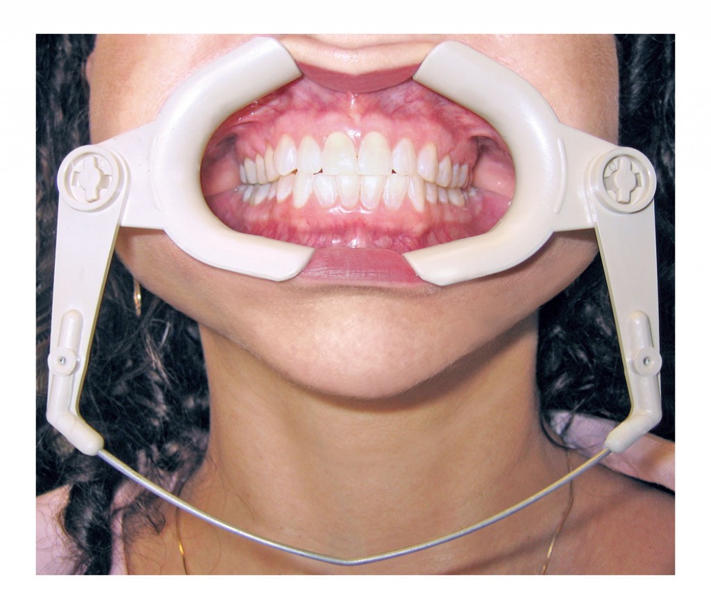 High Heat Adjustable Cheek Retractor – Orthodontic Supply & Equipment ...