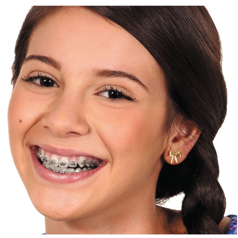 iD-Logical Stainless Steel Brackets – Roth Technique .022 – Orthodontic ...