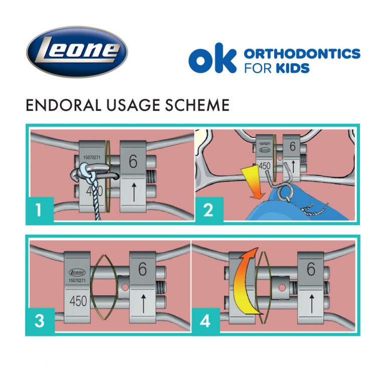 Leone Memoria Leaf Spring Activated Expander – Orthodontic Supply ...