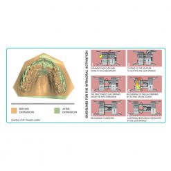 The Exspider Fan Type Expander – Orthodontic Supply & Equipment Company