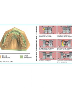 Leone Expansor 620 Rapid Palatal Expander – Orthodontic Supply ...