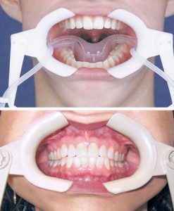 Products – Orthodontic Supply & Equipment Company