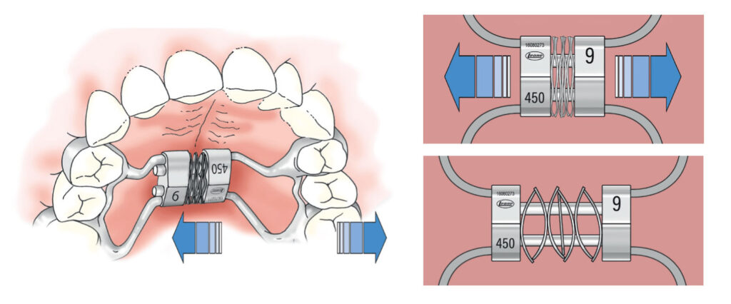 Leone Memoria Leaf Spring Self Expander – Orthodontic Supply ...